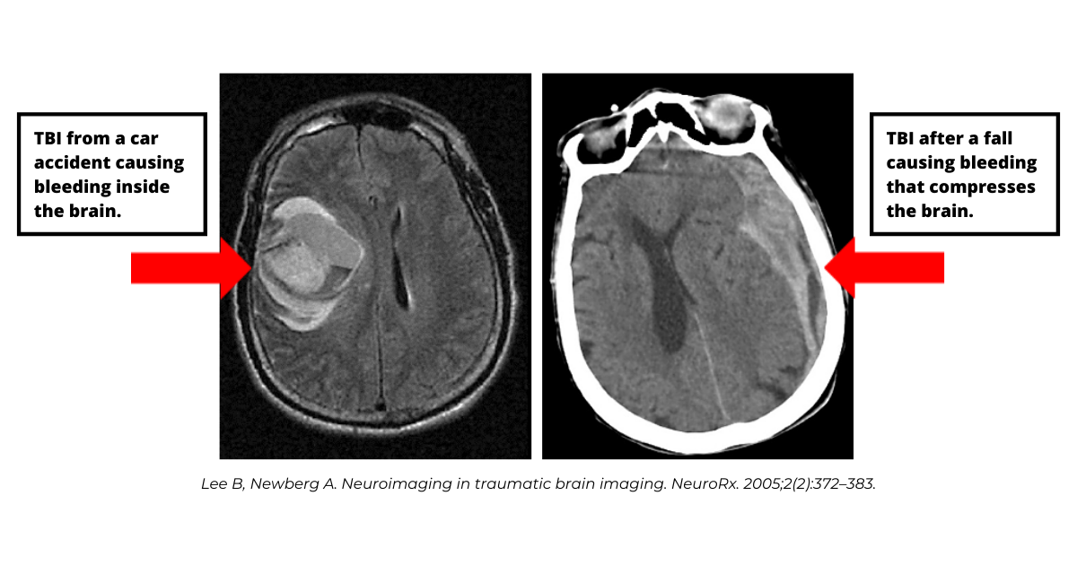 Traumatic Brain Injury and Epilepsy | Epilepsy Foundation